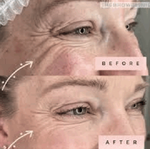 Plasma Fibroblasting Skin Tightening: Non-Invasive Treatment for ...
